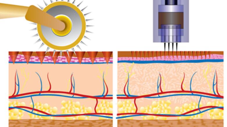 Everything You Need To Know For Dermarolling | XDermaRoller