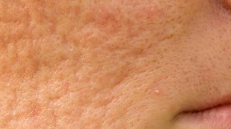 Derma Roller Solution for Acne Scar and Skin Imperfections