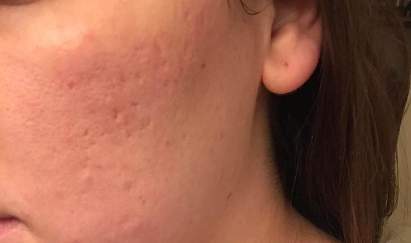 Derma Roller Solution for Acne Scar and Skin Imperfections