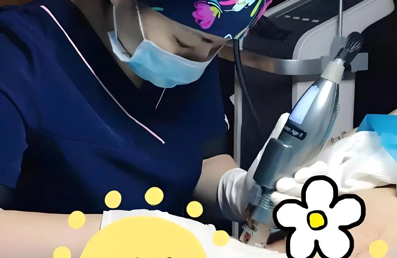 Does Body Derma Roller Microneedling Work for Stretch Marks? | Xdermaroller