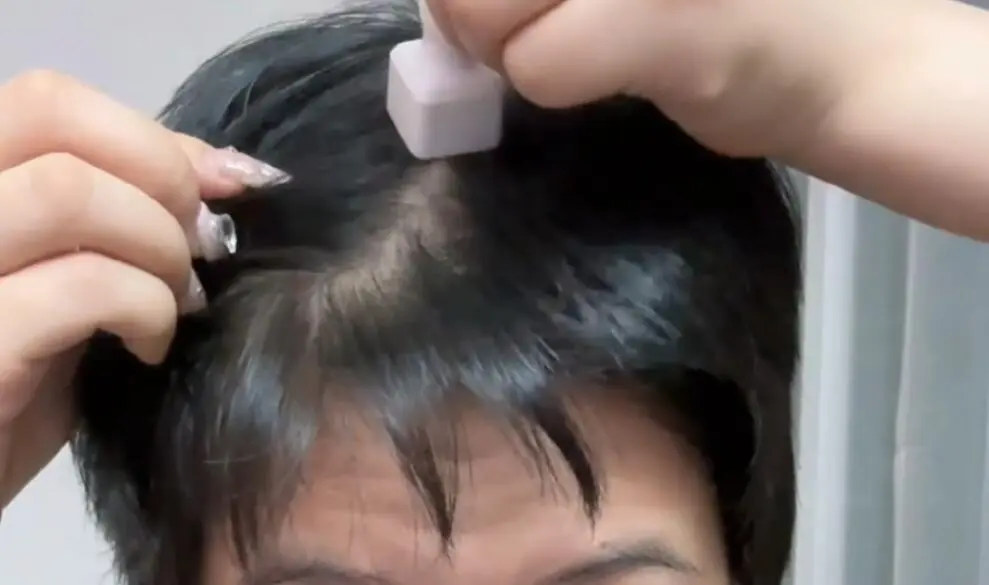 The Benefits of Derma Stamp for Hair Growth | Xdermaroller