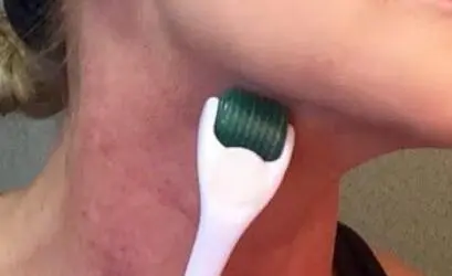 Best Derma Roller for Neck: How to Choose & Benefits | Xdermaroller