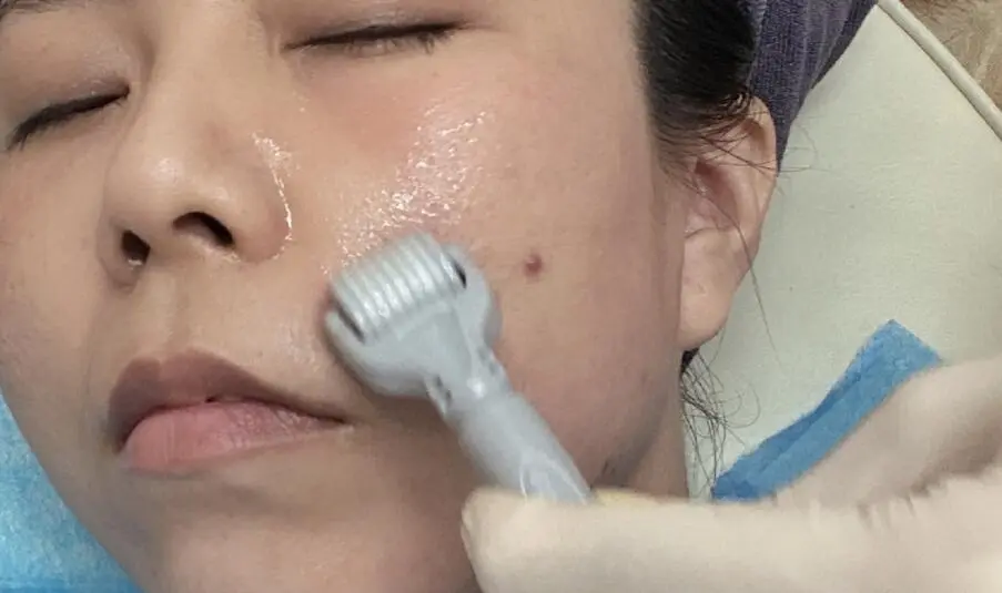 Are Derma Roller Results Permanent? | Xdermaroller