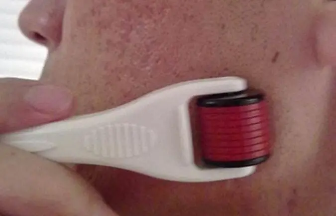 How to Use a Derma Roller for Acne Scars Safely | Xdermaroller