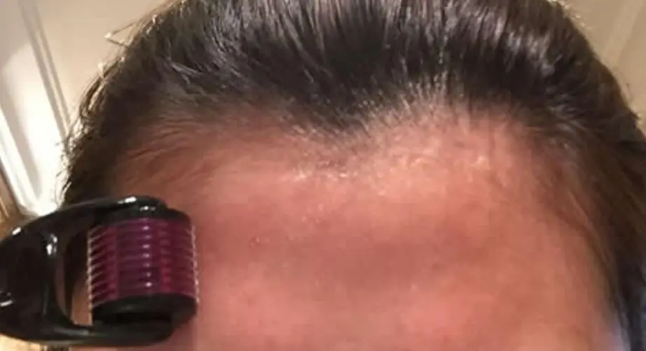 What Happens If You Overuse Derma Roller | Xdermaroller