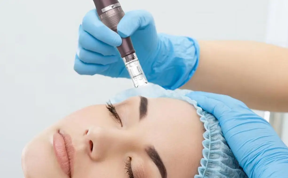 What Are The Benefits of Nano Needling For Skin Treatment? | Xdermaroller